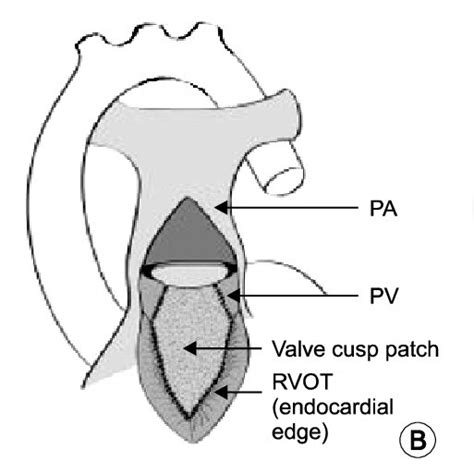 Pulmonary Cusp Augmentation Repair Technique A A Transannular Download Scientific Diagram