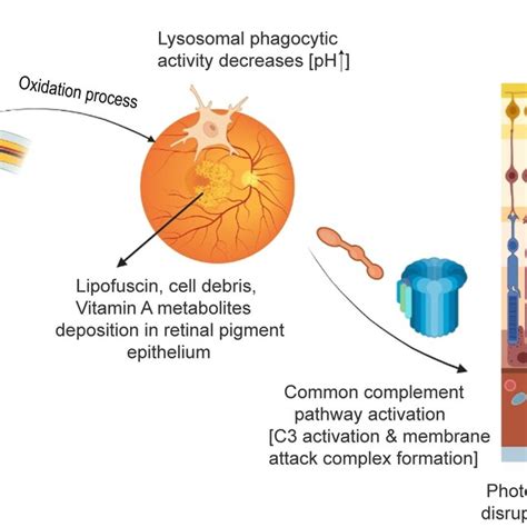 Pathogenesis Of Dry Age Related Macular Degeneration And Geographical Download Scientific
