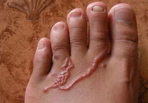 Parasites Under Human Skin