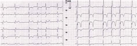 EKG Atrial Fibrillation Complete Right Bundle Branch Block Download Scientific Diagram