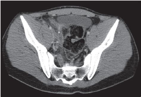 Ct Scan Of The Same Patient Shows Classical Appearance Of Appendicitis