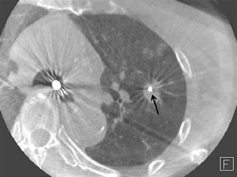 Computed Tomography Guided Transbronchial Lung Biopsy With Biopsy Download Scientific Diagram