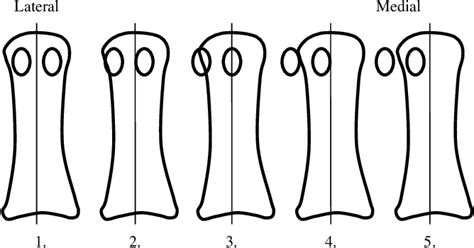 Figure 1 From The Influence Of The Length Of The First Metatarsal On
