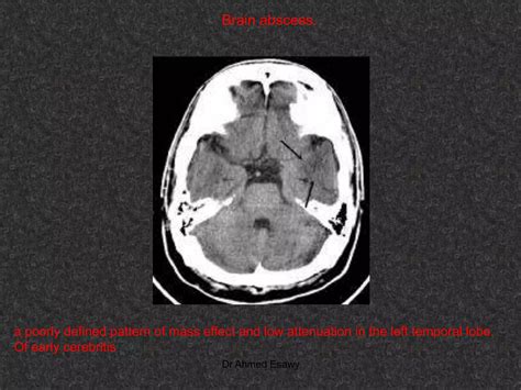 Intracranial Inflammatory Cystic Lesion Dr Ahmed Esawy Ct Mri Part 3 Ppt