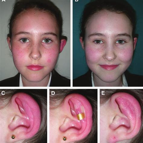 Pdf Earfold Implantable Clip System For Correction Of Prominent Ears