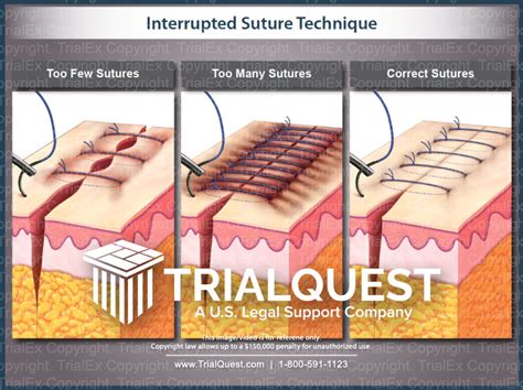 Interrupted Suture Technique TrialExhibits Inc