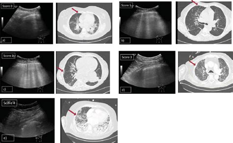Grading System Of Lung Opacities Used For The Lung Aeration Score In Download Scientific