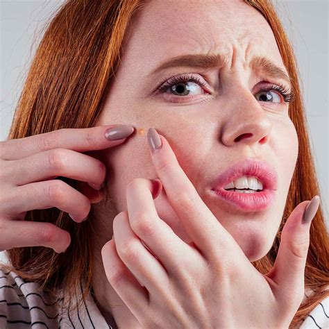 How To Remove Pimples Naturally
