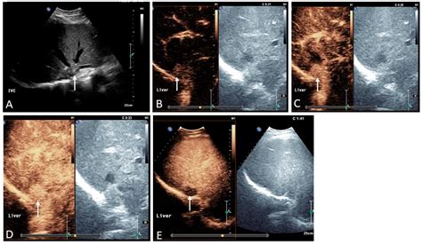 Imaging In Vascular Liver Diseases