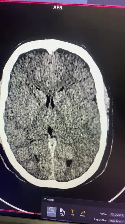 Shuvo Raj On Linkedin Hypodensity In Left Temporal Region Early Acute Infarct
