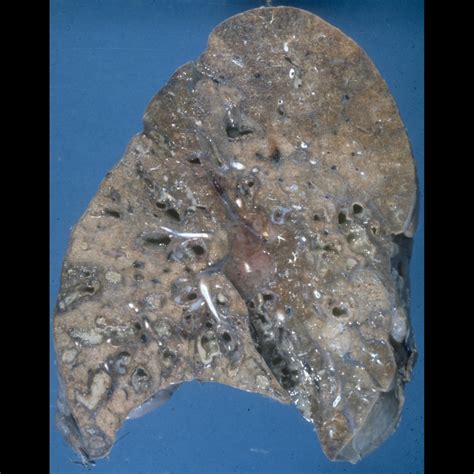 Pediatric Bronchiectasis Pediatric Radiology Reference Article