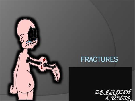 Fracture Types And Management Along With Natural Haeling Ppt