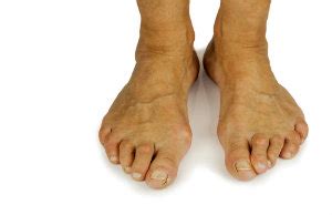 What Causes Toes To Curl Family Foot Ankle