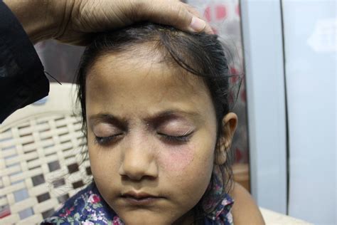 Full Recovery In Case Of Abcd Airborne Contact Dermatitis And