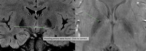 Lesions In Globus Pallidus Carbon Monoxide Poisoning