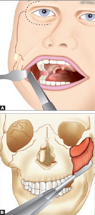 Zygomatic Arch Fracture Treatment