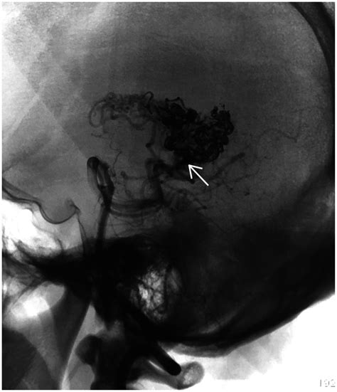 Update Onyx Embolization For Plexiform Arteriovenous Malformation Ante