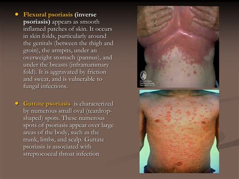 Ppt Psoriasis Powerpoint Presentation Free Download Id9735607