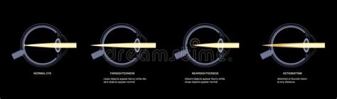 Refractive Errors Poster Stock Vector Illustration Of Farsightedness