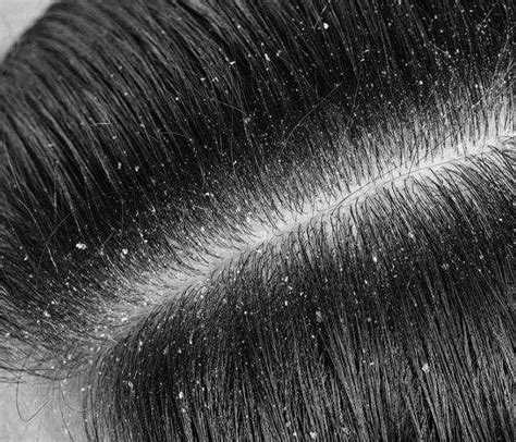 表情 头屑不断可能是这个原因这种路边野草洗头时用一用能去屑 表情