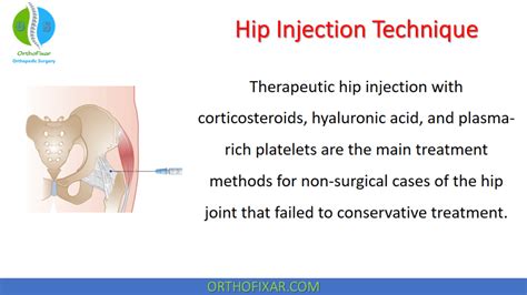 Hip Injection Technique Easily Step By Step Orthofixar