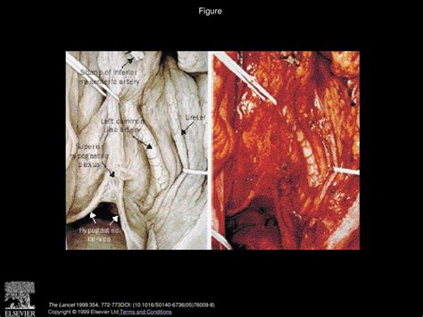 A Plea For Preservation Of The Pelvic Autonomic Nerves Ppt Download