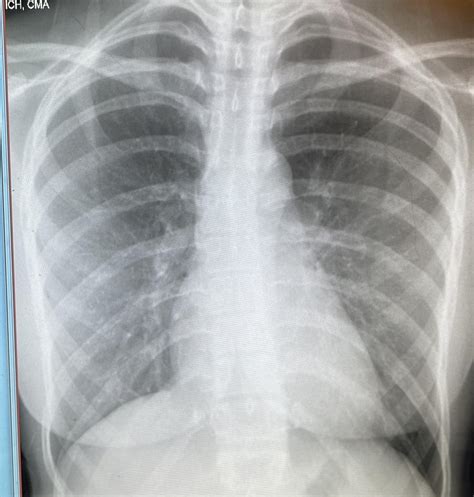 Lung X Ray Abnormalities Raskdoctorsmeeee