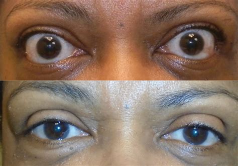 Exophthalmos Unilateral Disorders And Conditions Of The Eye
