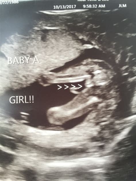 16 Week Gender Ultrasound Glow Community