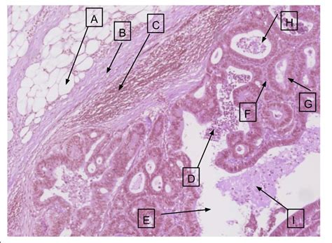 Label The Picture And Explain The Histology Of Lymp Node With Tumour