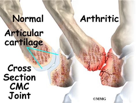 Artificial Joint Replacement Of The Thumb