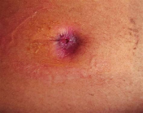 An Unusual Presentation Of Tuberculosis At Atypical Anatomical Location