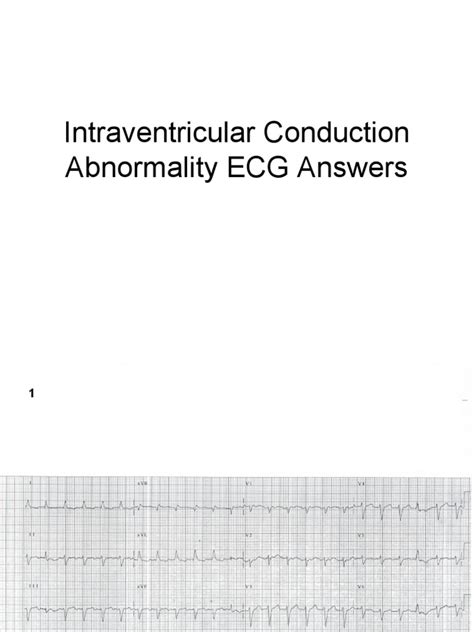 Intraventricular Conduction Abnormality Ecg Pdf Electrocardiography Physiology