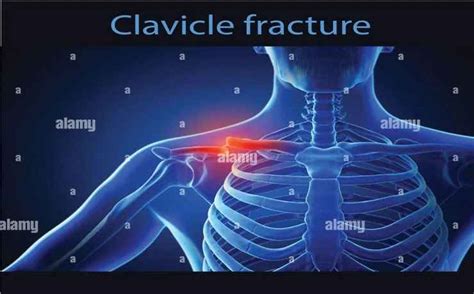 Clavicle Fracture Broken Collarbone Its Causes Symptoms Diagnosis