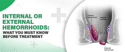 Internal Or External Hemorrhoids What You Need To Know Before Treatment