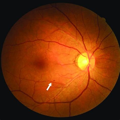 Fundus Photography Of A Retinal Hemorrhage In The Right Eye A Small Download Scientific