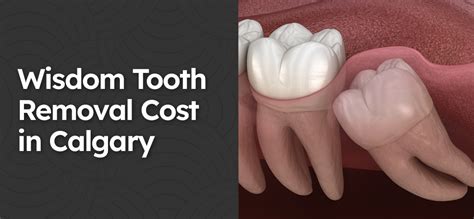 Wisdom Tooth Removal Cost In Calgary Sierra Dental
