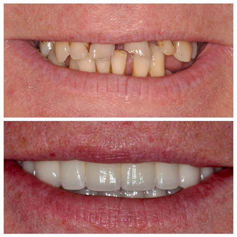 Pterygoid Implants Tuberosity And Pterygomaxillary Dental Implant