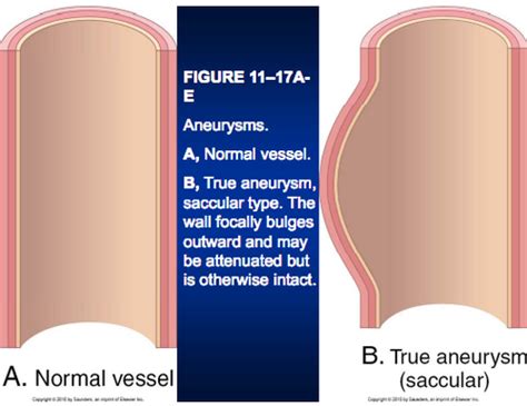 Pathophys Test 2 CV Circulation Flashcards Quizlet Pathophys Test 2 CV Circulation Flashcards Quizlet