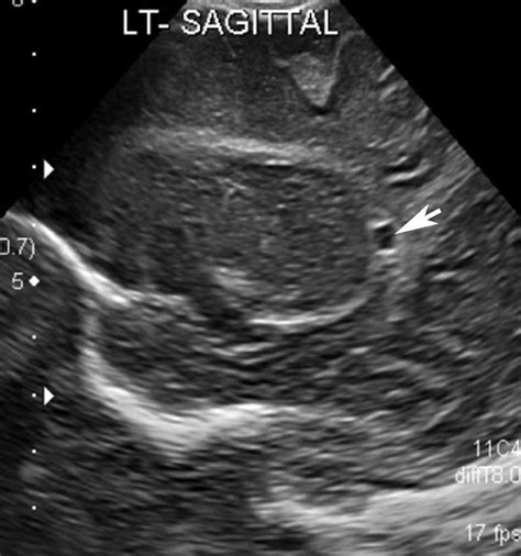 Choroid Plexus Cyst Head Us Parasagittal Plane In A Term Neonate Shows Download Scientific