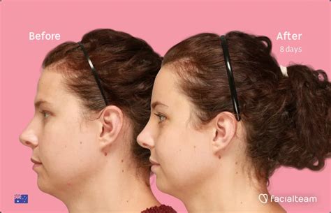 Charlie Before And After Ffs Surgery — Facialteam
