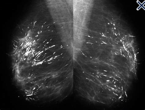 Rodrigo Arrangoiz Ms Md Facs Fsso On Linkedin Breast Calcifications