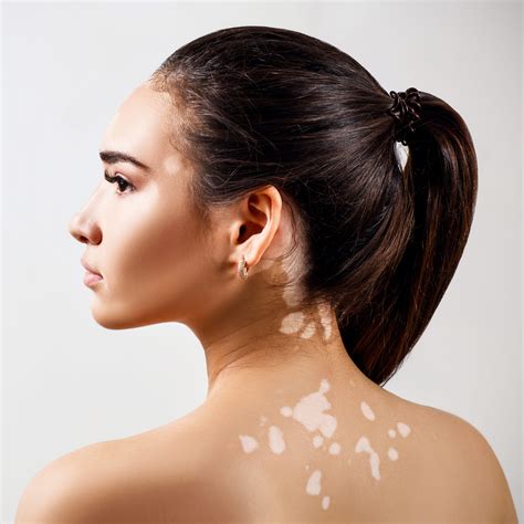 Vitiligo Sintomas Diagnóstico E Tratamento Dr Daniel Stellin