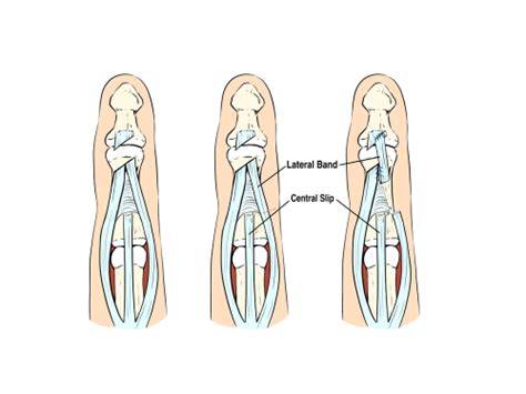 Trigger Finger Sagittal Band Injury Subluxing Lateral Band