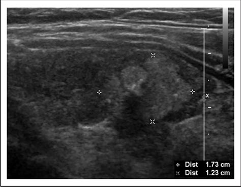 Figure 3 From The Role Of The Acr Ti Rads Scoring System To Evaluate
