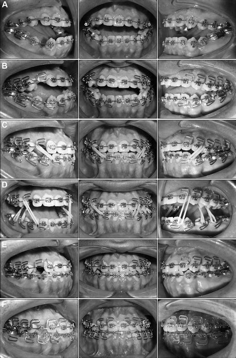 Treatment Progress A Leveling And Alignment B Multiloop Edgewise Download Scientific