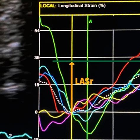 Atrial Segmentation For Longitudinal Strain Quantification Using 2d Download Scientific Diagram