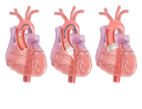 Aortic Valve Replacement