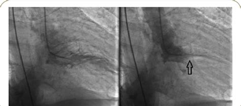 Left Ventriculogram In Diastole 4b Left Ventriculogram In End Systole