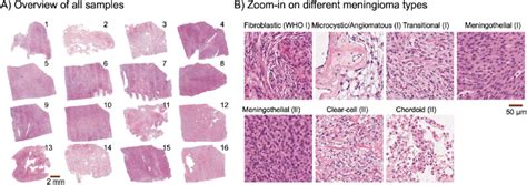 Meningioma Histology Meningioma Dna Methylation Groups Identify